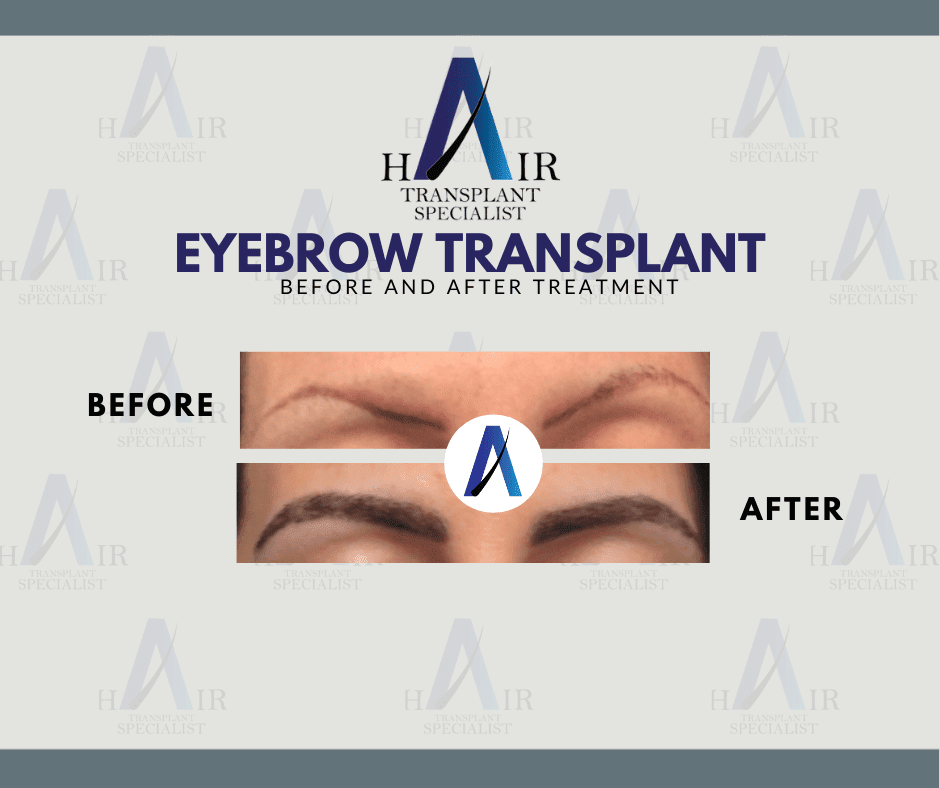 Perkhidmatan - Advanced Tanam Rambut Malaysia