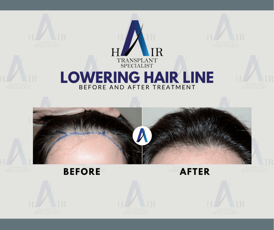 Hasil Turunkan Garis Rambut - Advanced Tanam Rambut Malaysia