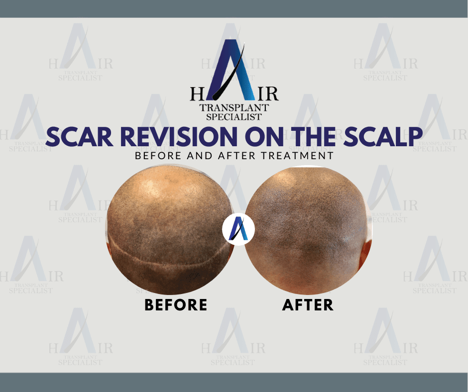 Perkhidmatan - Advanced Tanam Rambut Malaysia