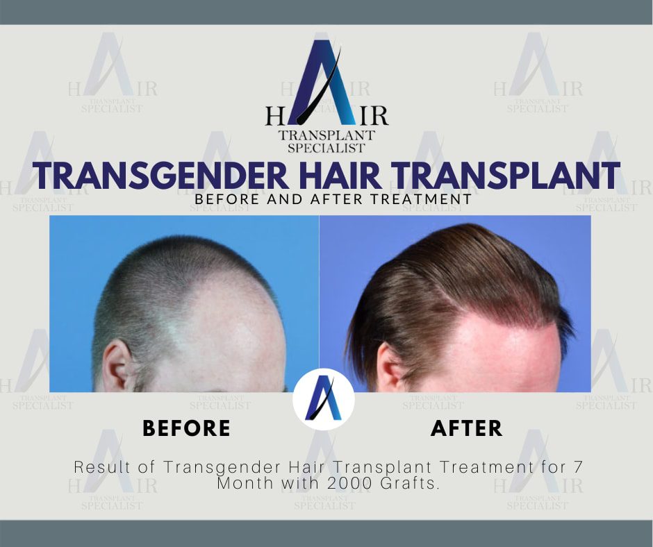 Perkhidmatan - Advanced Tanam Rambut Malaysia