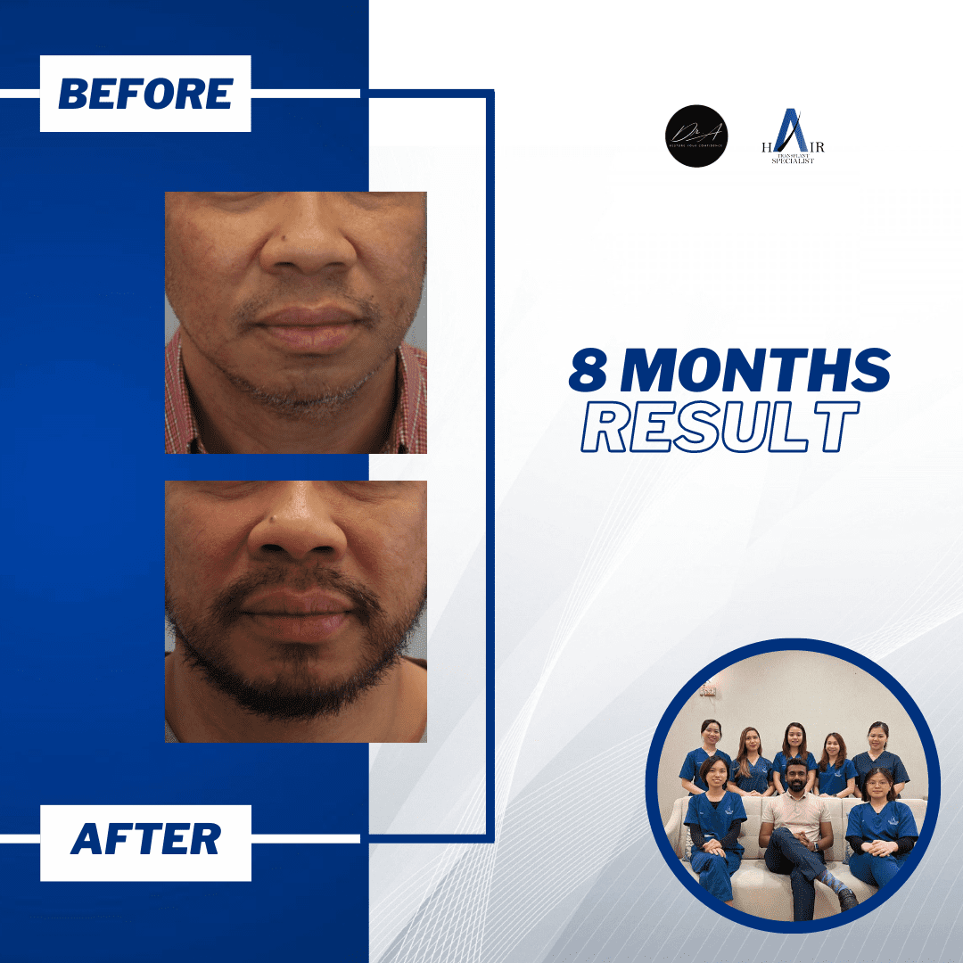 Perkhidmatan - Advanced Tanam Rambut Malaysia