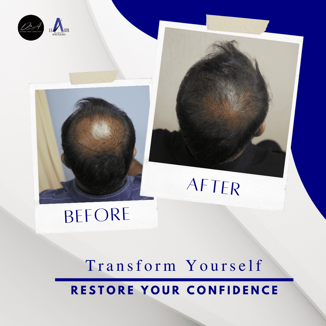 Hasil Tanam Rambut Atas - Advanced Tanam Rambut Malaysia