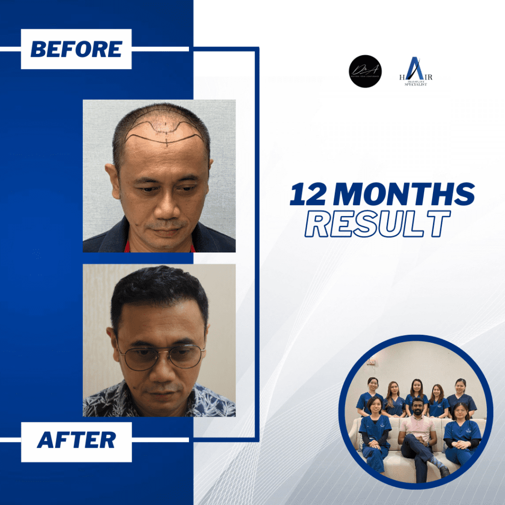 Perkhidmatan - Advanced Tanam Rambut Malaysia